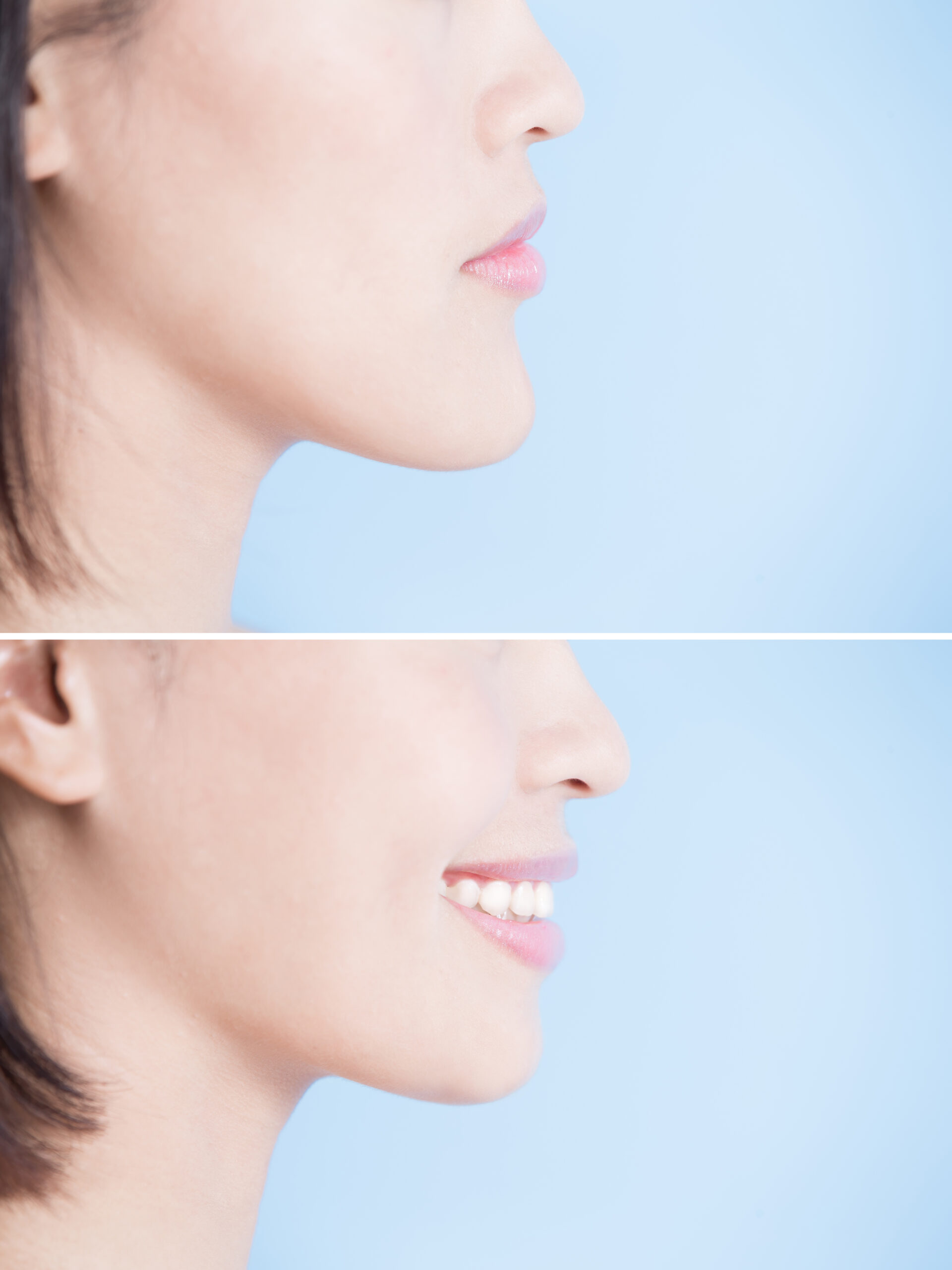 Keeping Smiles Strong With Jaw Surgery