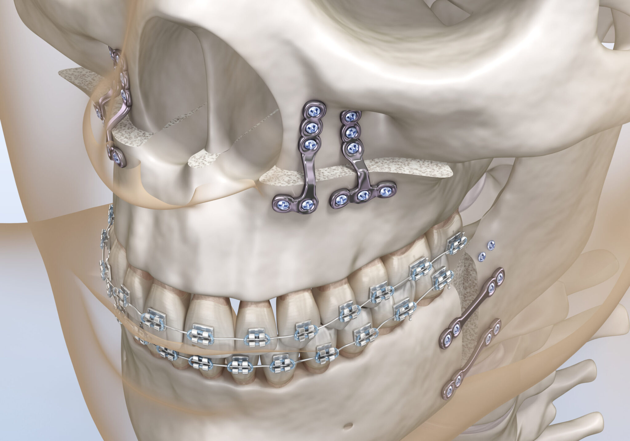 Our Approach To Corrective Jaw Surgery
