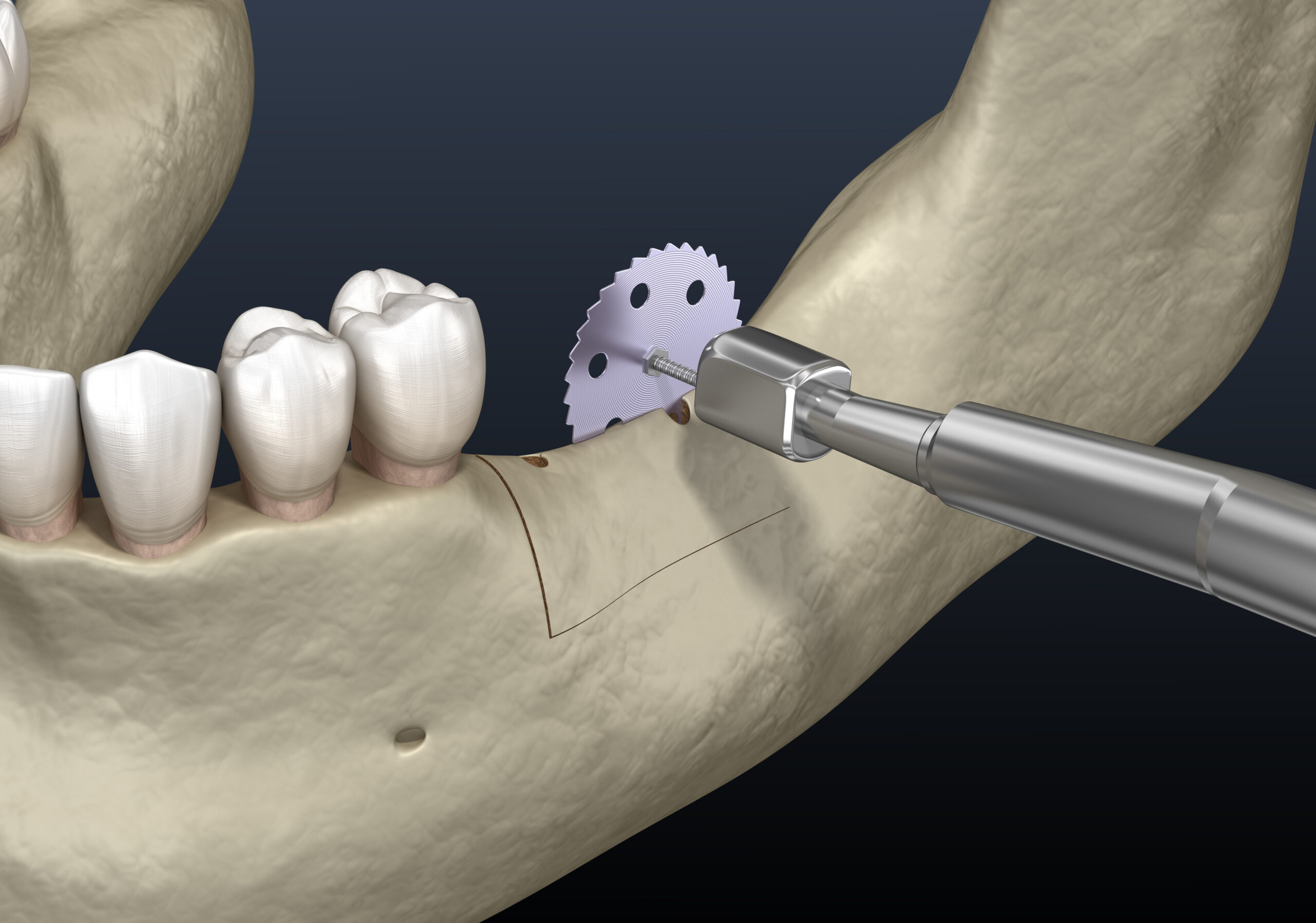 Strengthening Smiles With A Ridge Augmentation